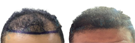 تجربتي مع مركز هيريكا لزراعة الشعر: التكلفة والنتيجة | دكتور بلس